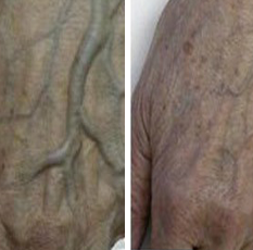 St Louis Vein Treatment Center | Missouri Vein Care and Vein Treatment