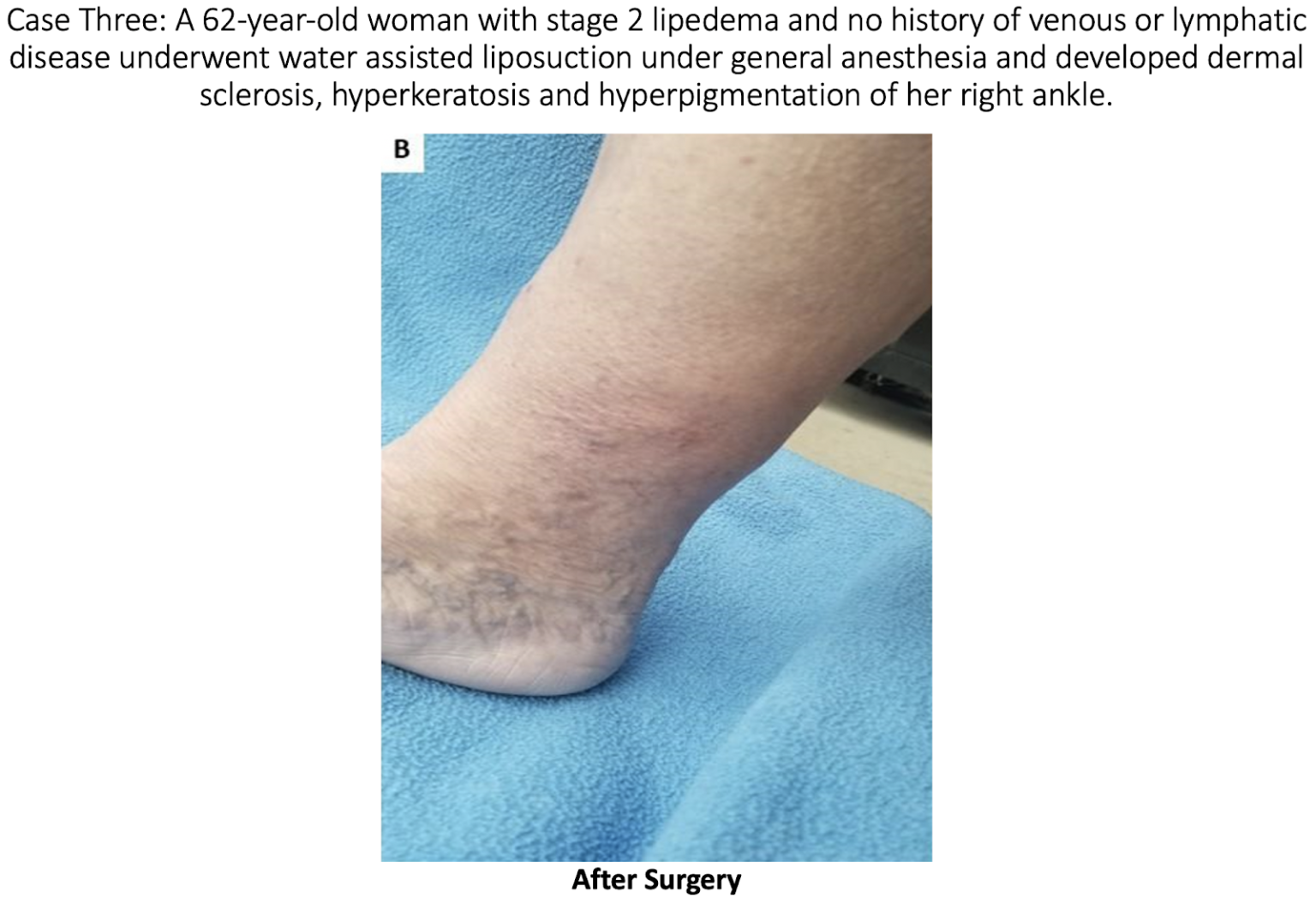 Lymphatic Injury After Liposuction for Lipedema - St Louis Laser Veins