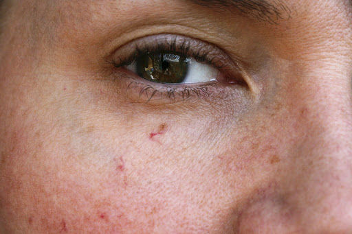Treat Your Facial Veins With Our Preferred Patient Program! | SLLV