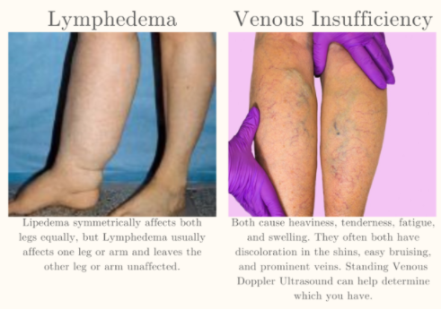 Understanding Lipedema & Veinous Insufficiency | St Louis Laser Vein