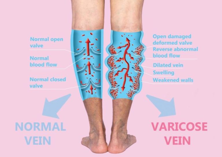 Benefits of IPL for Spider Veins | St Louis Laser Veins