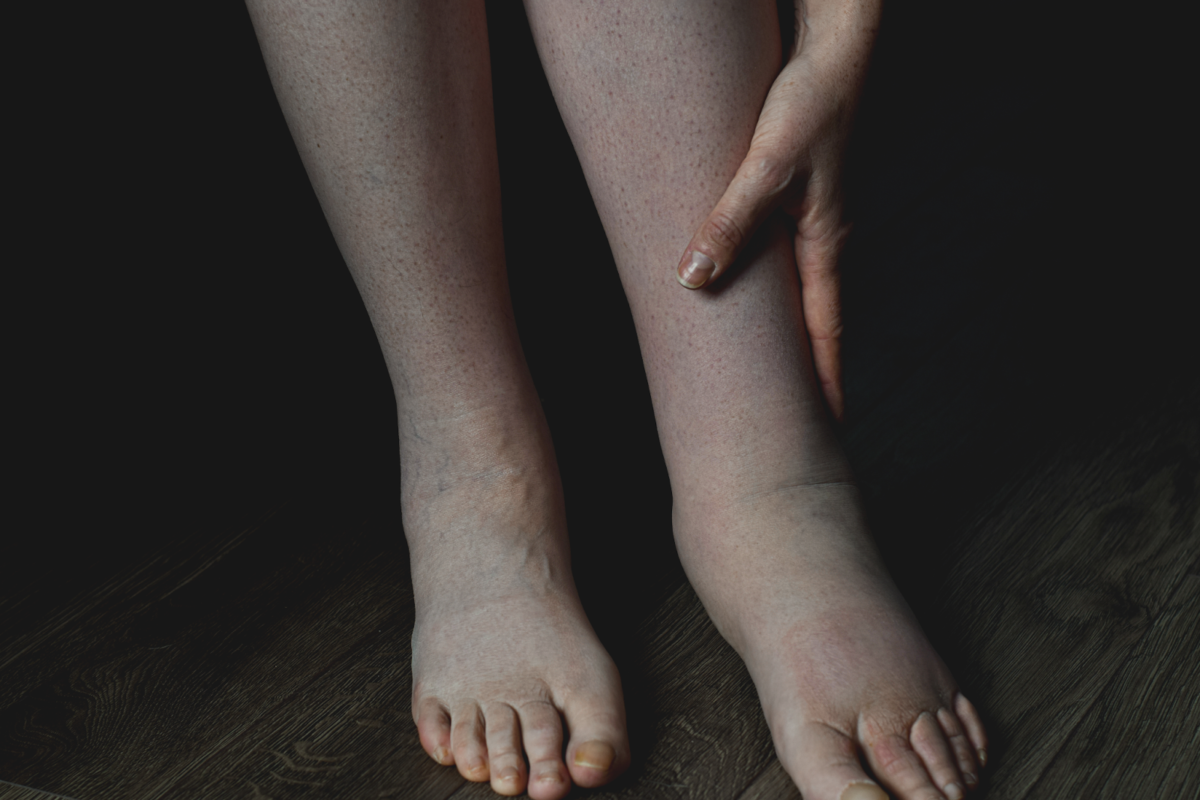 Federal Bill Increases Lymphatic Disease Research | St Louis Laser Veins