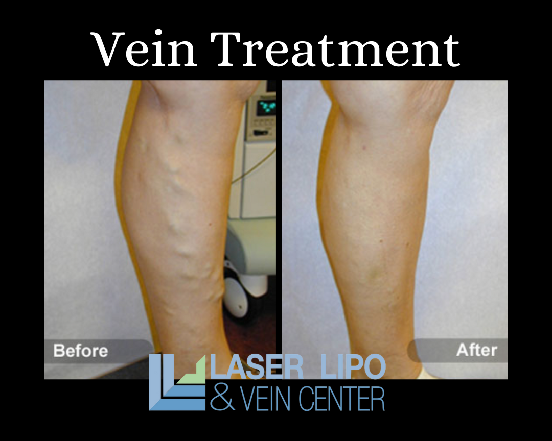 Effective Leg Vein Treatments | St Louis Laser Veins