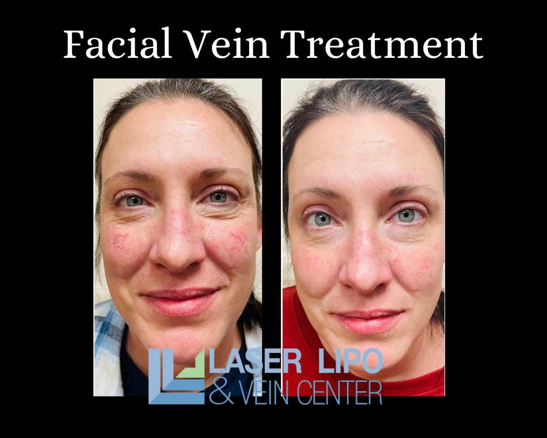 Effective Leg Vein Treatments | St Louis Laser Veins