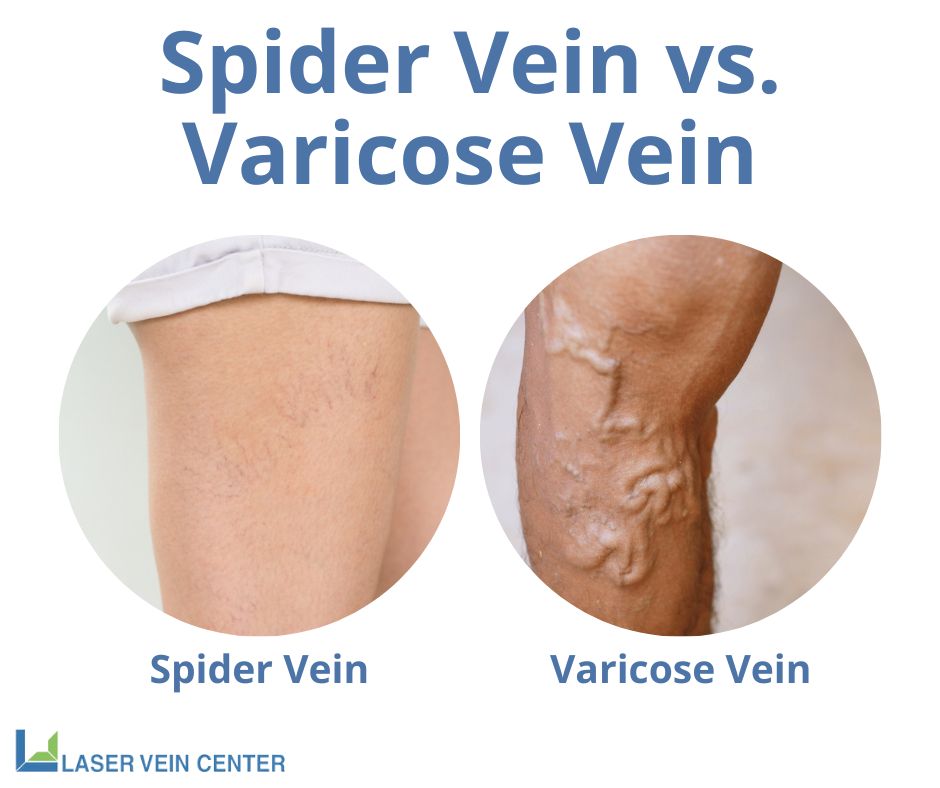 Spider Veins Unmasked: Causes, Prevention, and Treatment Options - St ...