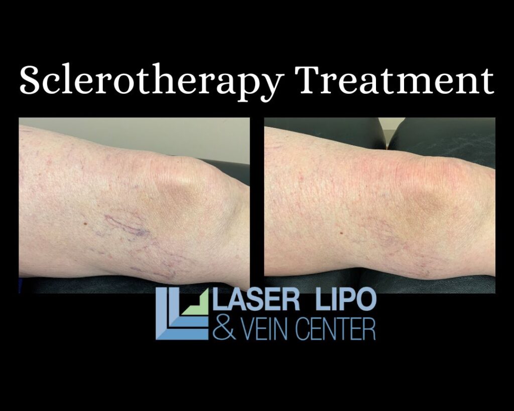 Types of Veins that Can Be Treated with Sclerotherapy | St Louis Laser ...