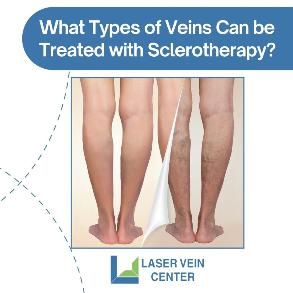 Types of Veins that Can Be Treated with Sclerotherapy | St Louis Laser ...